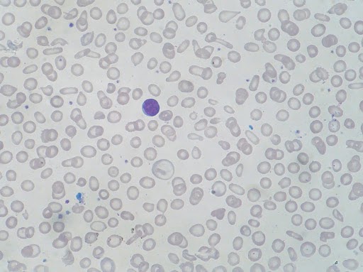 Hematologia: Anemias Microcíticas e Hipocrômicas: importância do ...