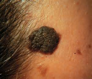 Cherry Angioma: Cherry Angioma Cancer