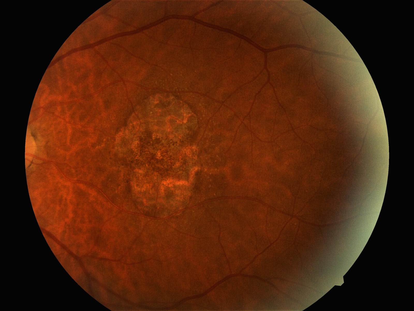 Sonoran Desert Eye Center: GEOGRAPHIC ATROPHY