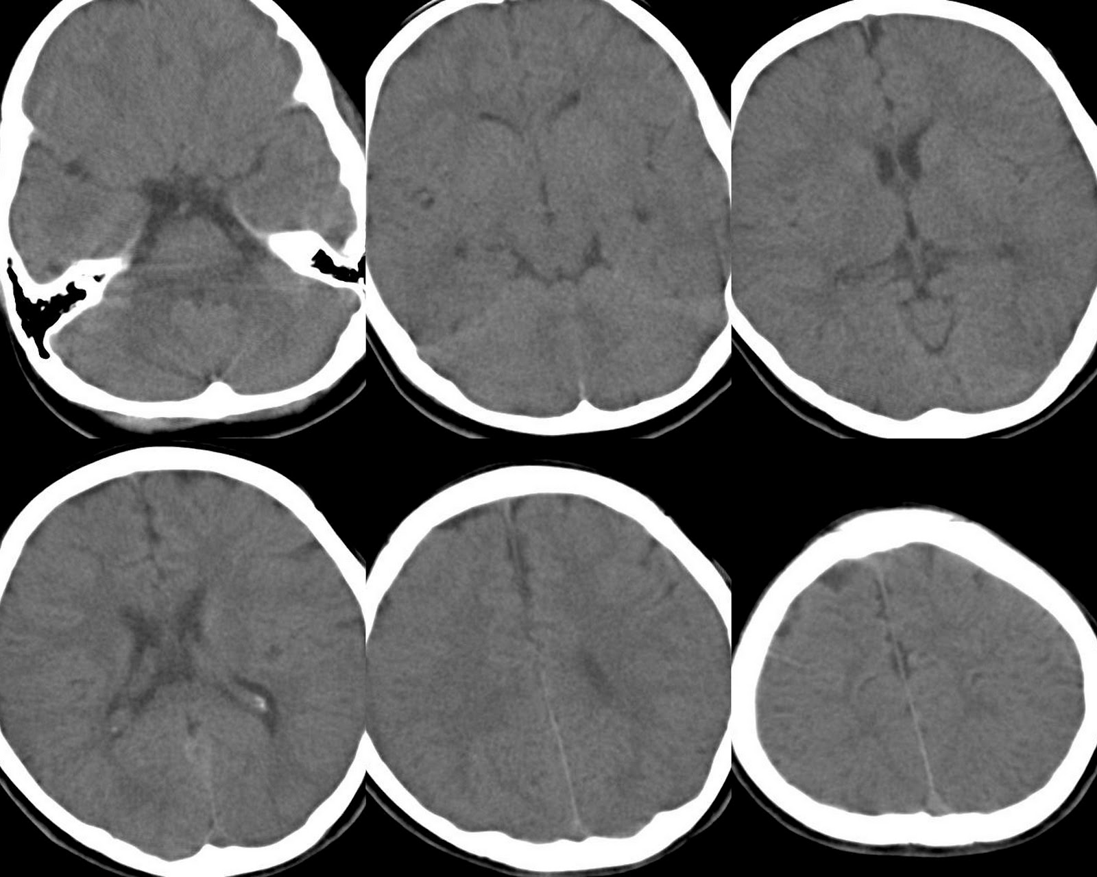 Hypoxia-Ischemia, Brain; Anoxia-Ischemia, Brain; Anoxia-Ischemia ...