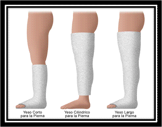 Fracturas