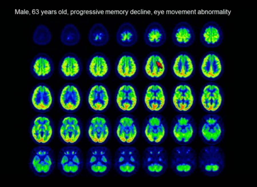 rsna: FDG PET for dementia