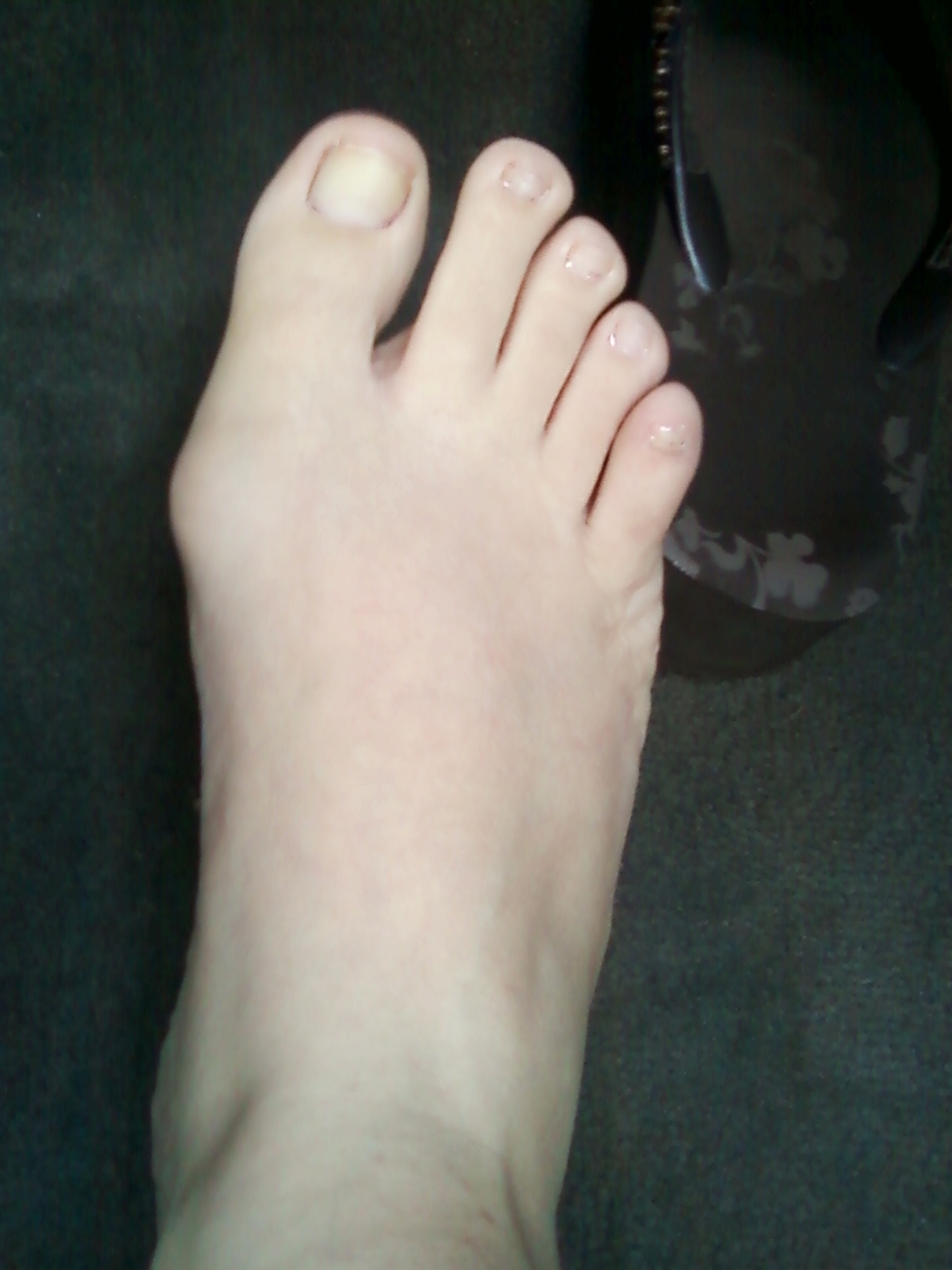 Austin Bunionectomy: The Day of Surgery