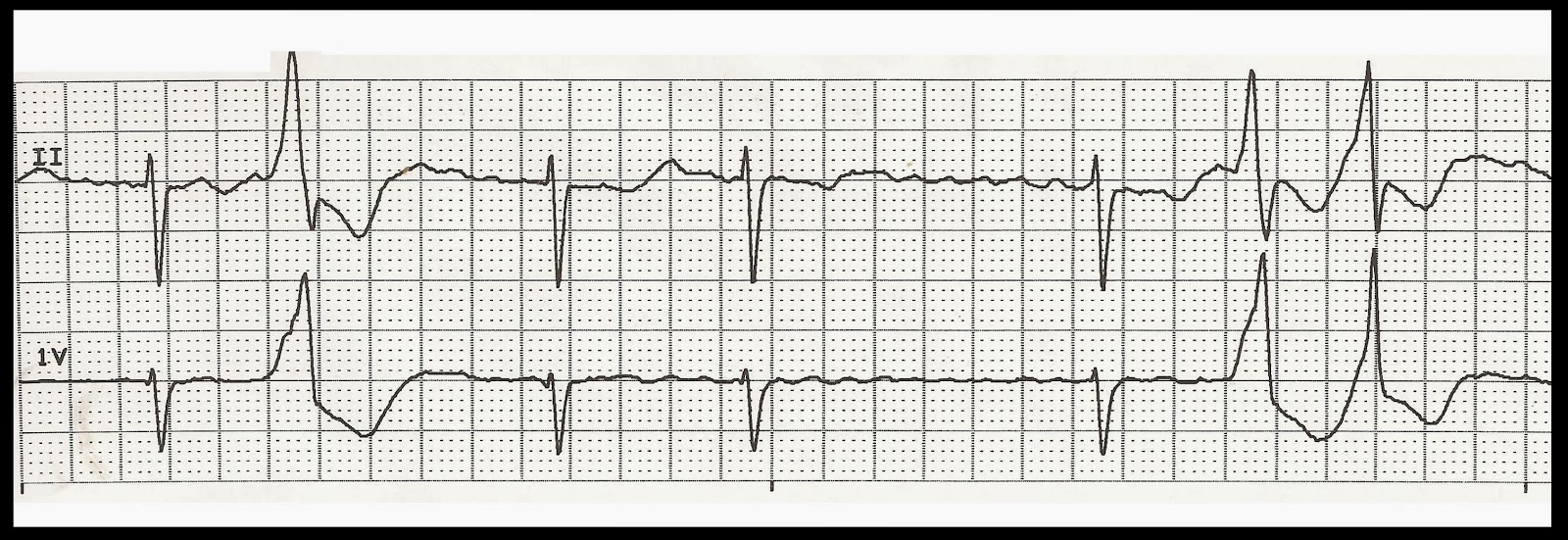 Float Nurse: EKG Rhythm Strip Quiz 185