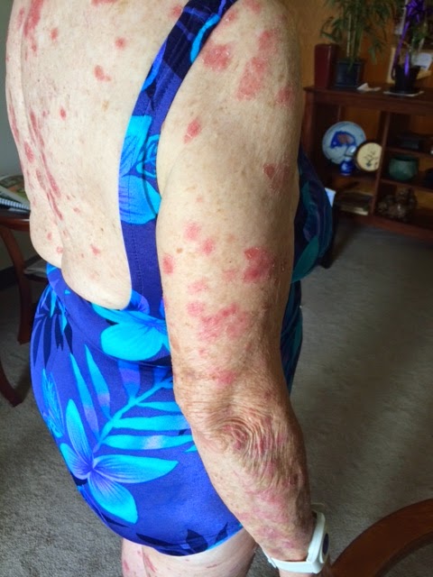 VIRTUAL GRAND ROUNDS IN DERMATOLOGY 2.0: Generalized Dermatitis in an ...