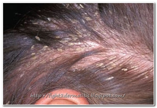 Dermatitis in Hair | Let us Fight To DERMATITIS
