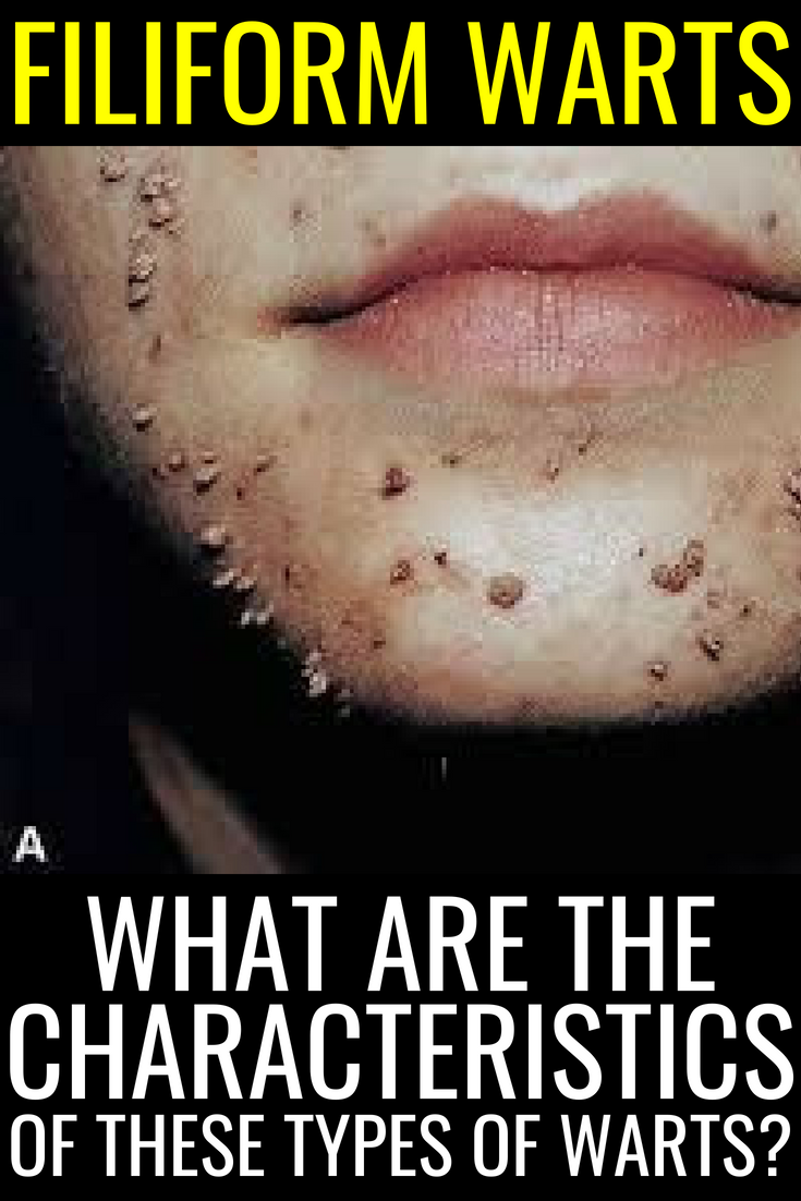 Filiform Warts - What Are the Characteristics of These Types of Warts?
