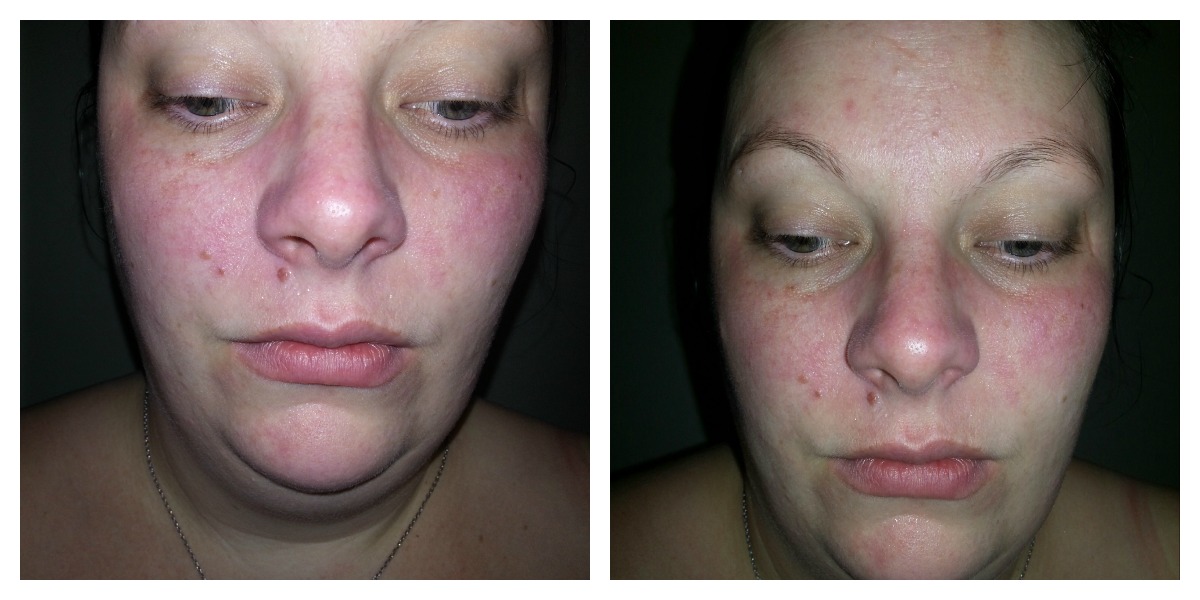 Katy's beauty secrets: How-to: Deal with an allergic reaction.