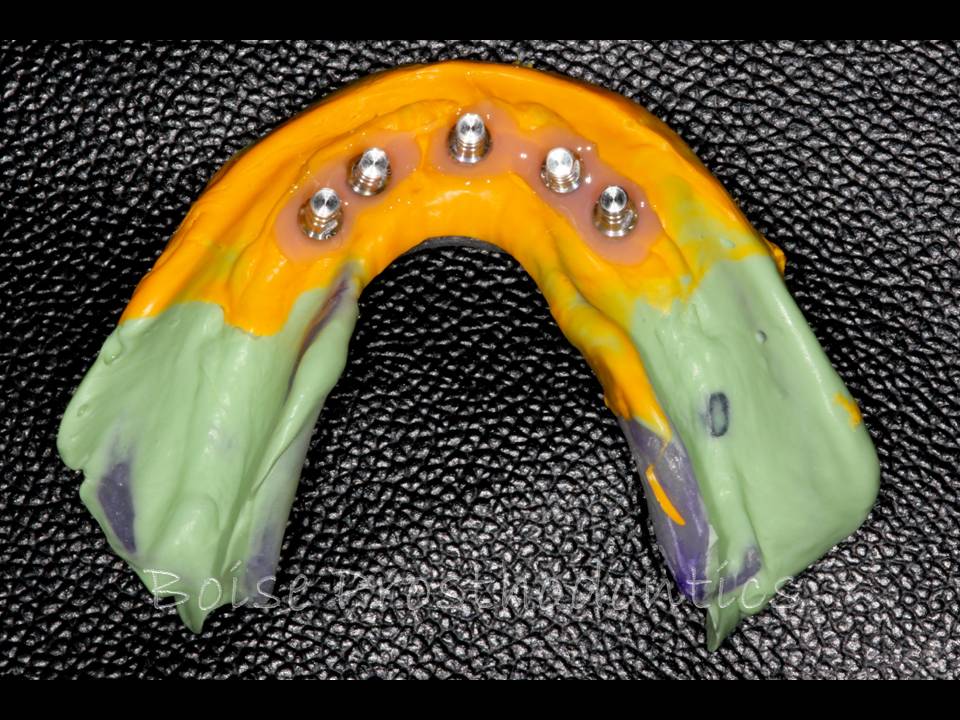 Boise Idaho Prosthodontics: Picture Sequence of Maxillary Complete ...