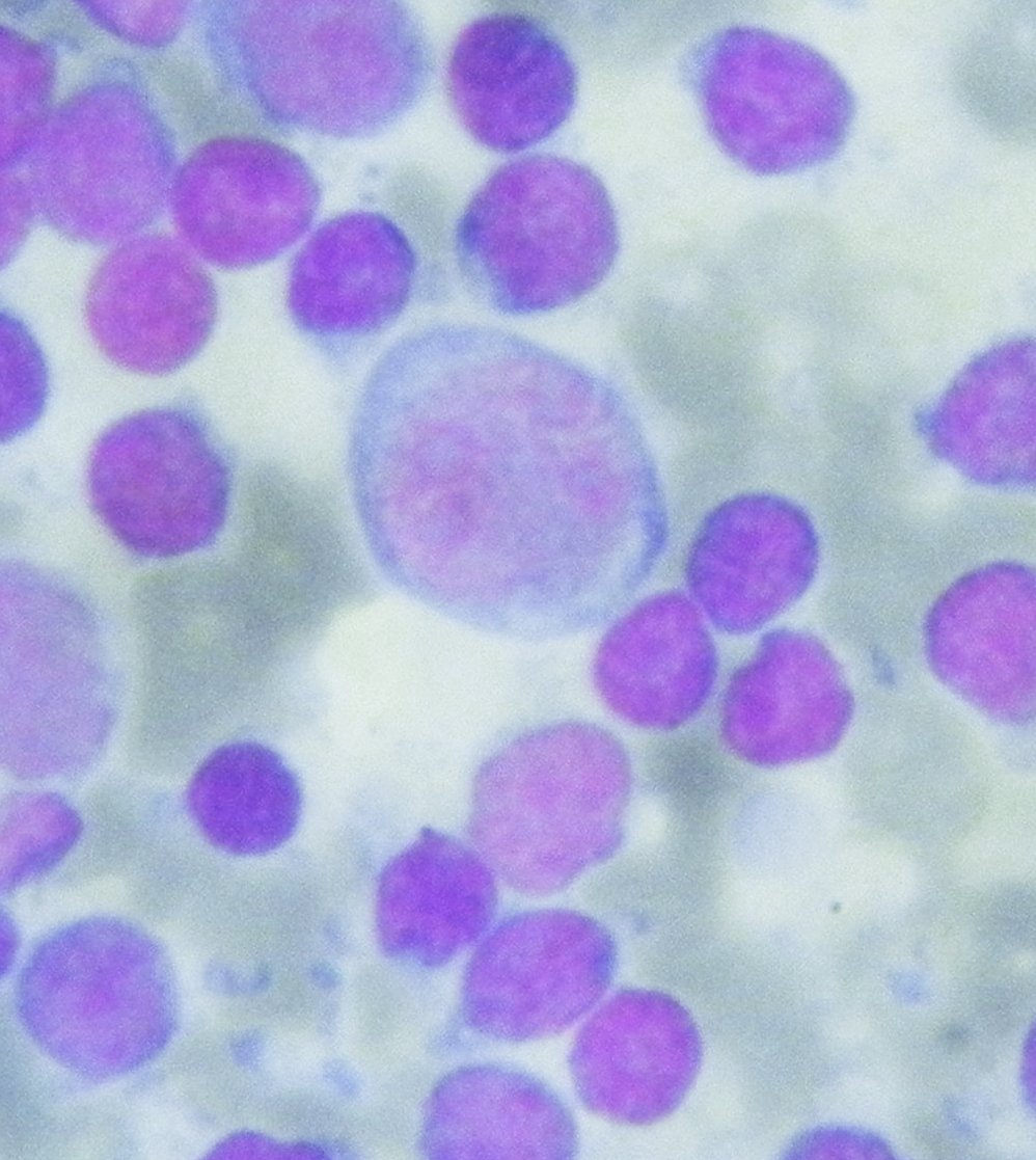 Findings from a lymph node