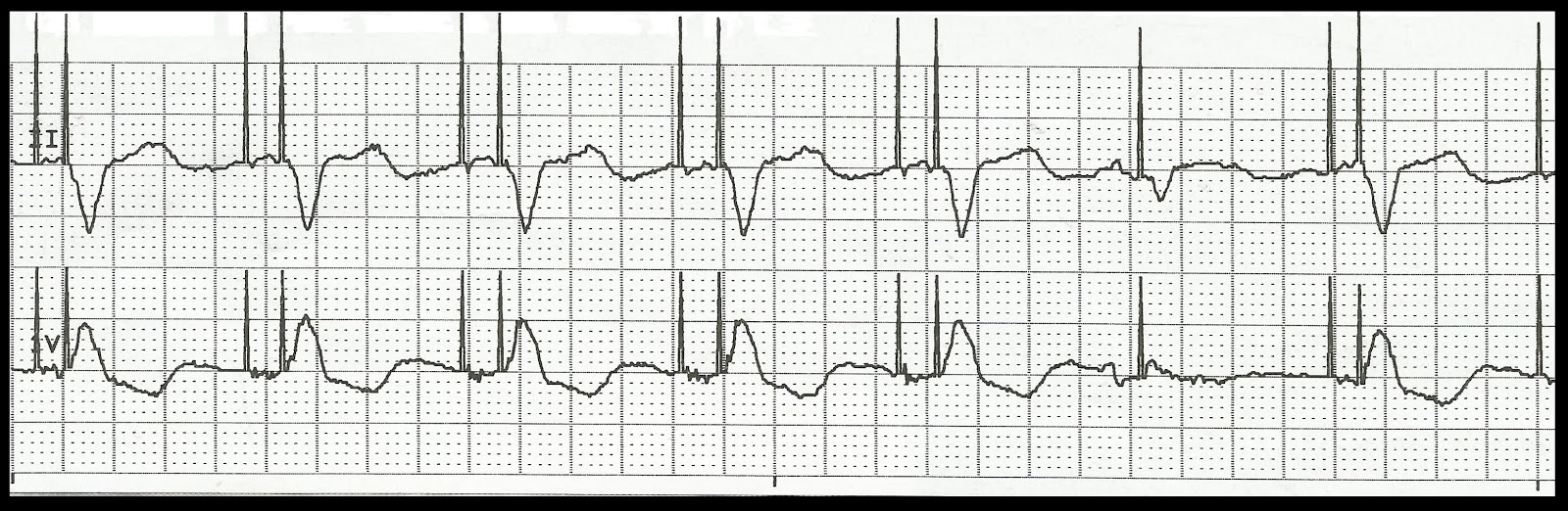 EKG Rhythm Strip Quiz 123