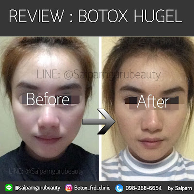 มาทำความรู้จัก "Botox Premium" จากเกาหลี Hugel Toxin