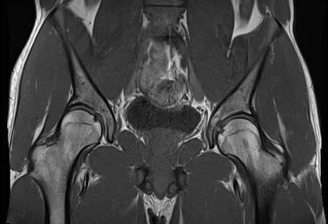 Athletic Pubalgia and Adductor Strain