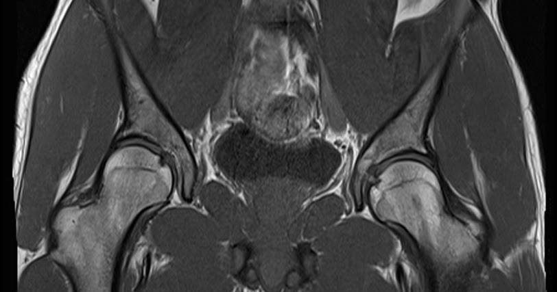 Athletic Pubalgia and Adductor Strain