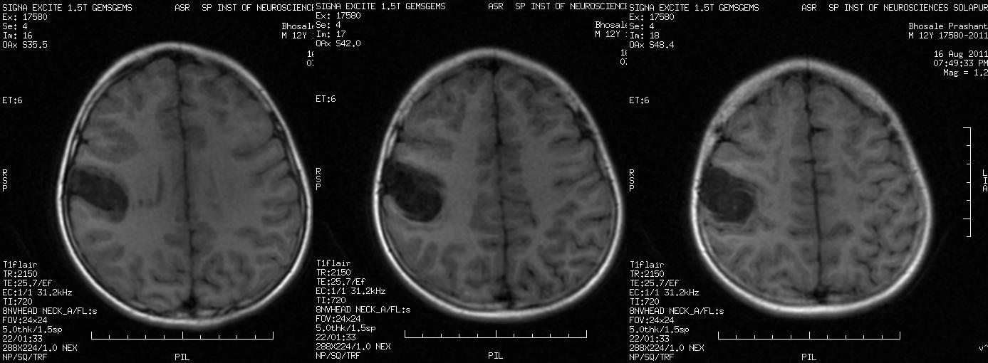 Dr Balaji Anvekar FRCR: Dysembryoplastic Neuro Epithelial Tumor (DNET)