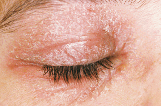 FATOS E FOTOS: DERMATITE DE CONTATO