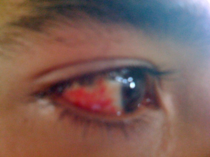 barbiesunrise: Leptospirosis