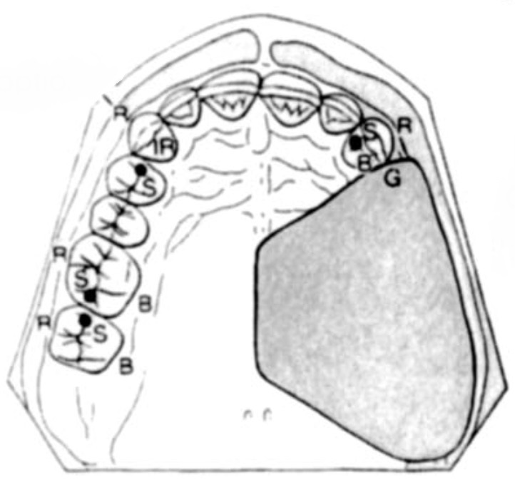 PMF Víctor Orduña: CLASIFICACIÓN DE DEFECTOS MAXILARES POSTQUIRÚRGICOS ...