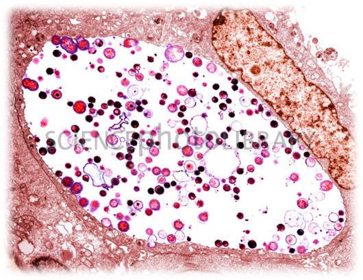 Prevencion de Enfermedades: Clamidia