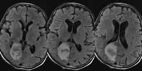 Dr Balaji Anvekar FRCR: Gyriform enhancement