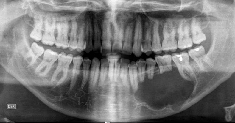 Estomatologia Online: Ameloblastoma