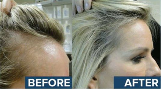 International Hair Restoration Systems Blog: Stem Cell Technology Used ...