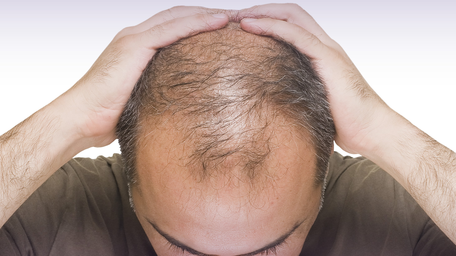 Mondo Farmacia: Alopecia androgenica (calvizie)