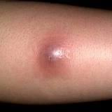 Medicina & Viata : Cele mai frecvente infectii ale pielii ...