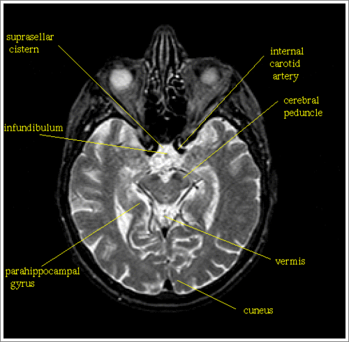 Basal cisterns | Brain Interactive