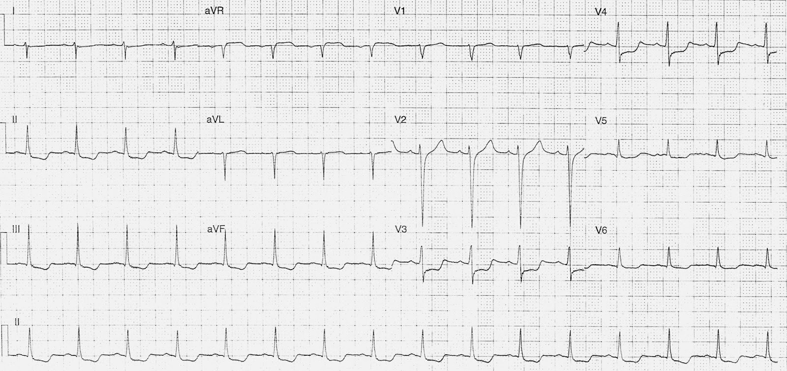 ECG of the Week: ECG of the Week - 20th February 2017 - Interpretation