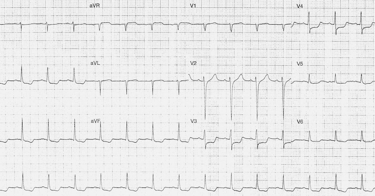 ECG of the Week: ECG of the Week - 20th February 2017 - Interpretation