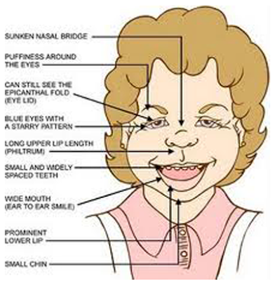 Angelman syndrome - Σύνδρομο 'Αγγελμαν ή Έιντζελμαν ΑS - Η ΔΙΑΔΡΟΜΗ