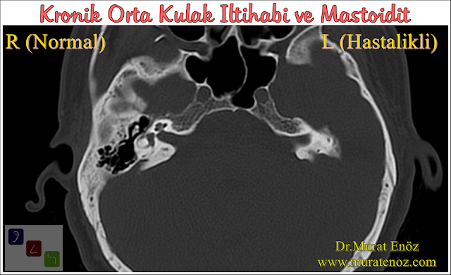 Kronik Orta Kulak İltihabı ve Mastoidit