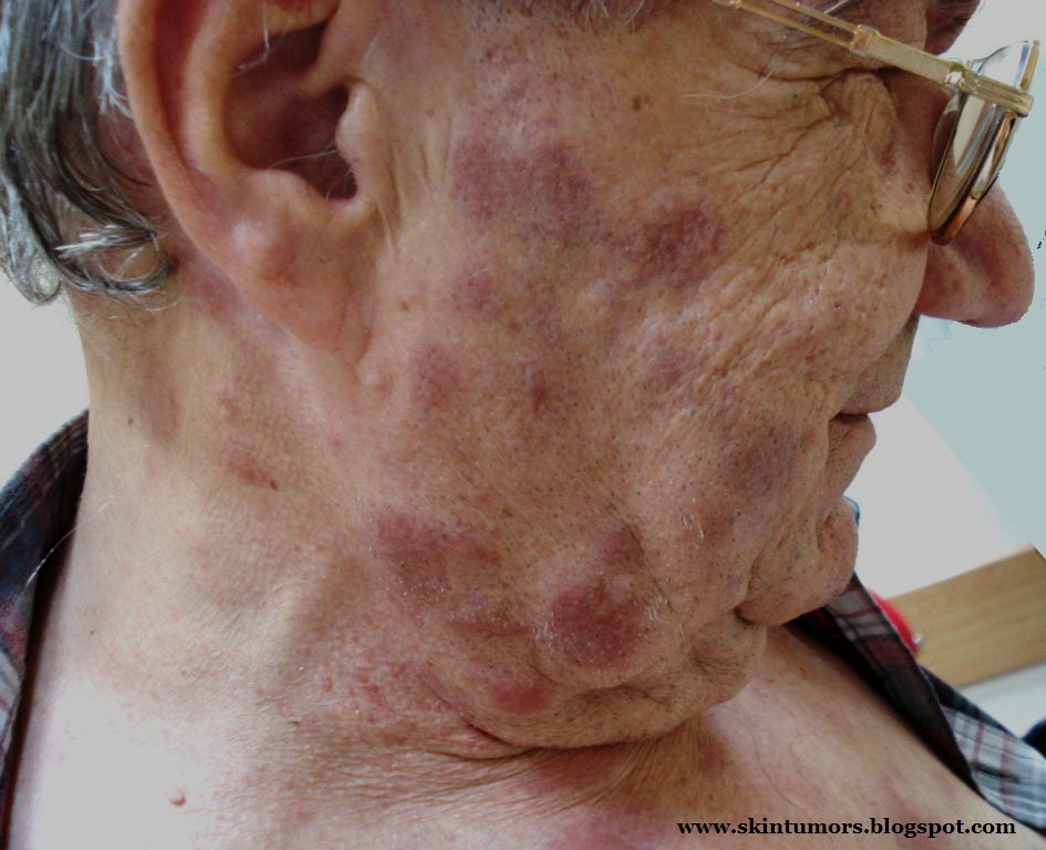 Skin Tumors B cell Lymphoma Skin Tumors B cell Lymphoma