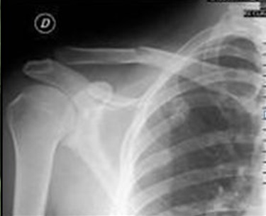 Radiología Silva2: Clavicula