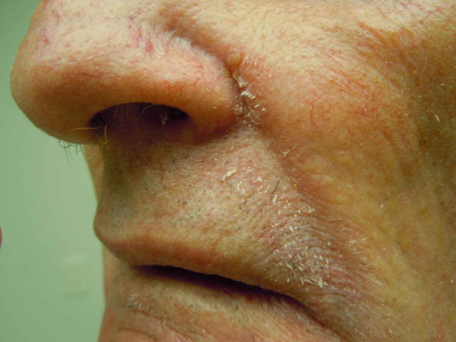 SKIN DISEASE TYPES: Seborrheic Dermatitis