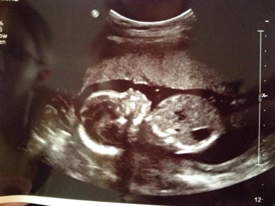 The Pregnant Doula: 19 weeks - Ultrasound & Gender Reveal TOMORROW!!