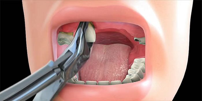 Video: Dental Abscess in 3d - OdontoVida