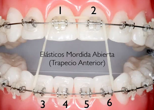 ORTODONCIA: Uso de los elásticos en Ortodoncia Fija