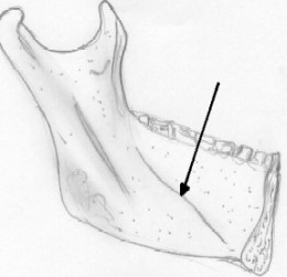 MCQ's in Facial Plastic & Reconstructive Surgery: 1161-1170 MCQ in ...