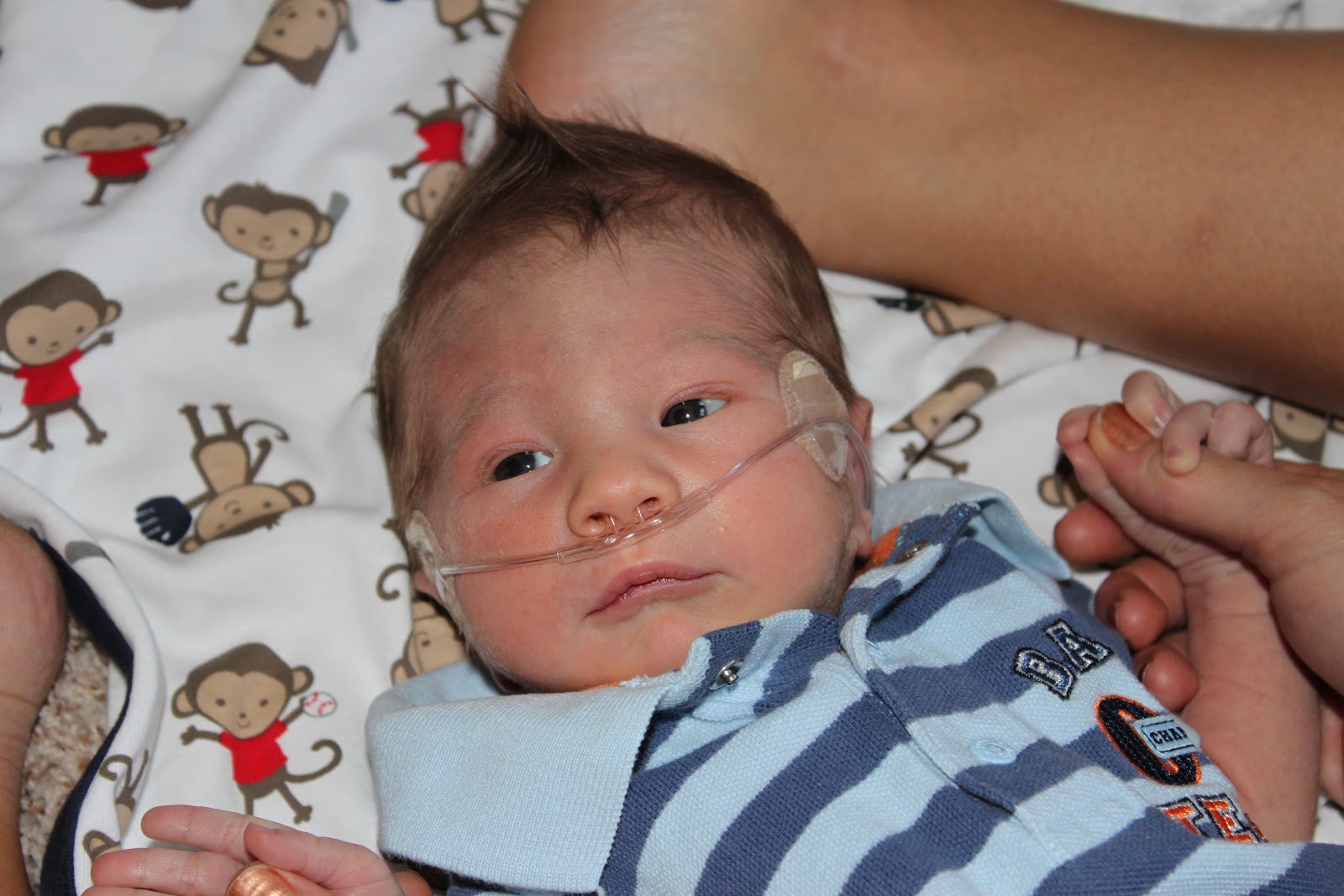 Metopic Craniosynostosis