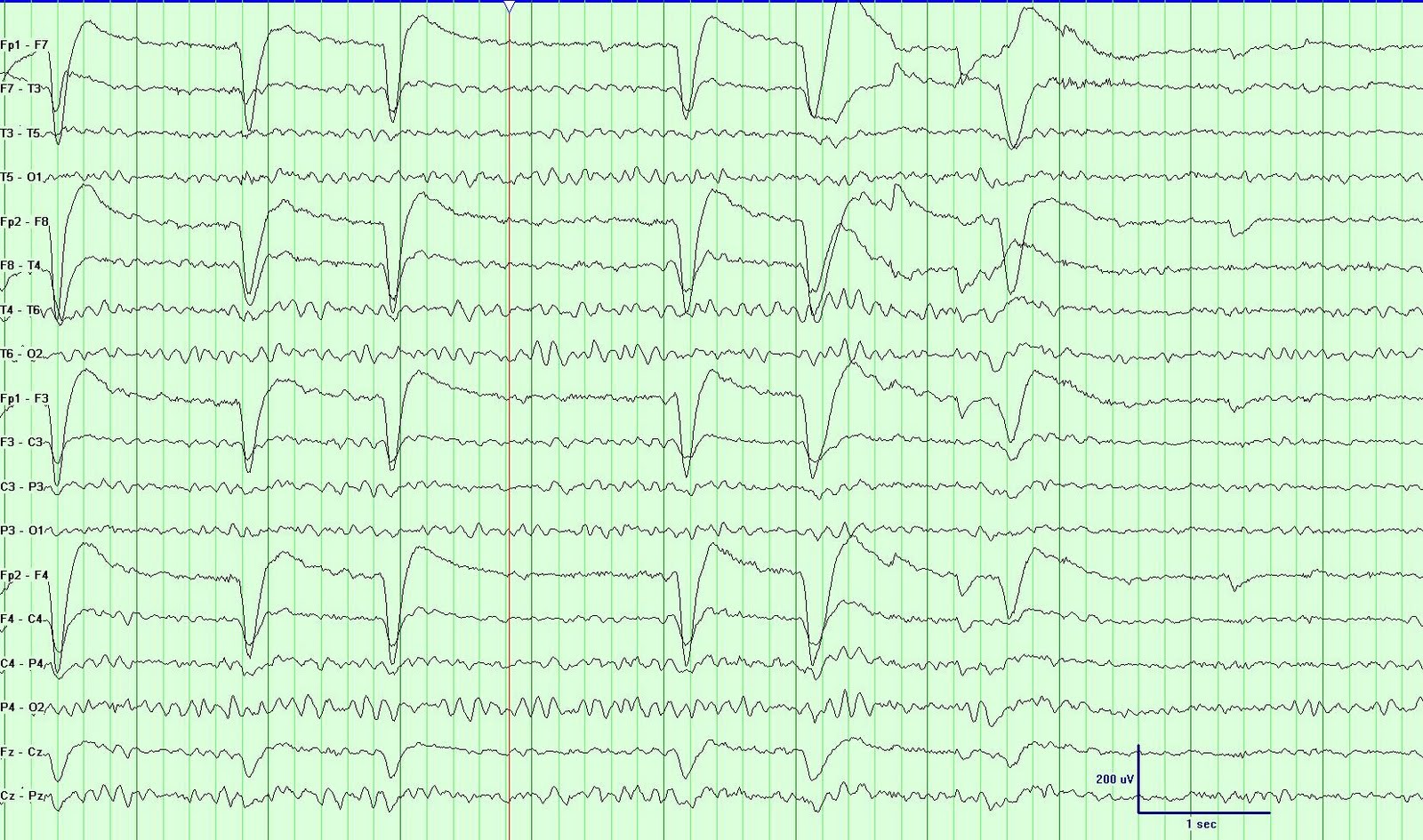 EEG Reviewer: EEG No. 1