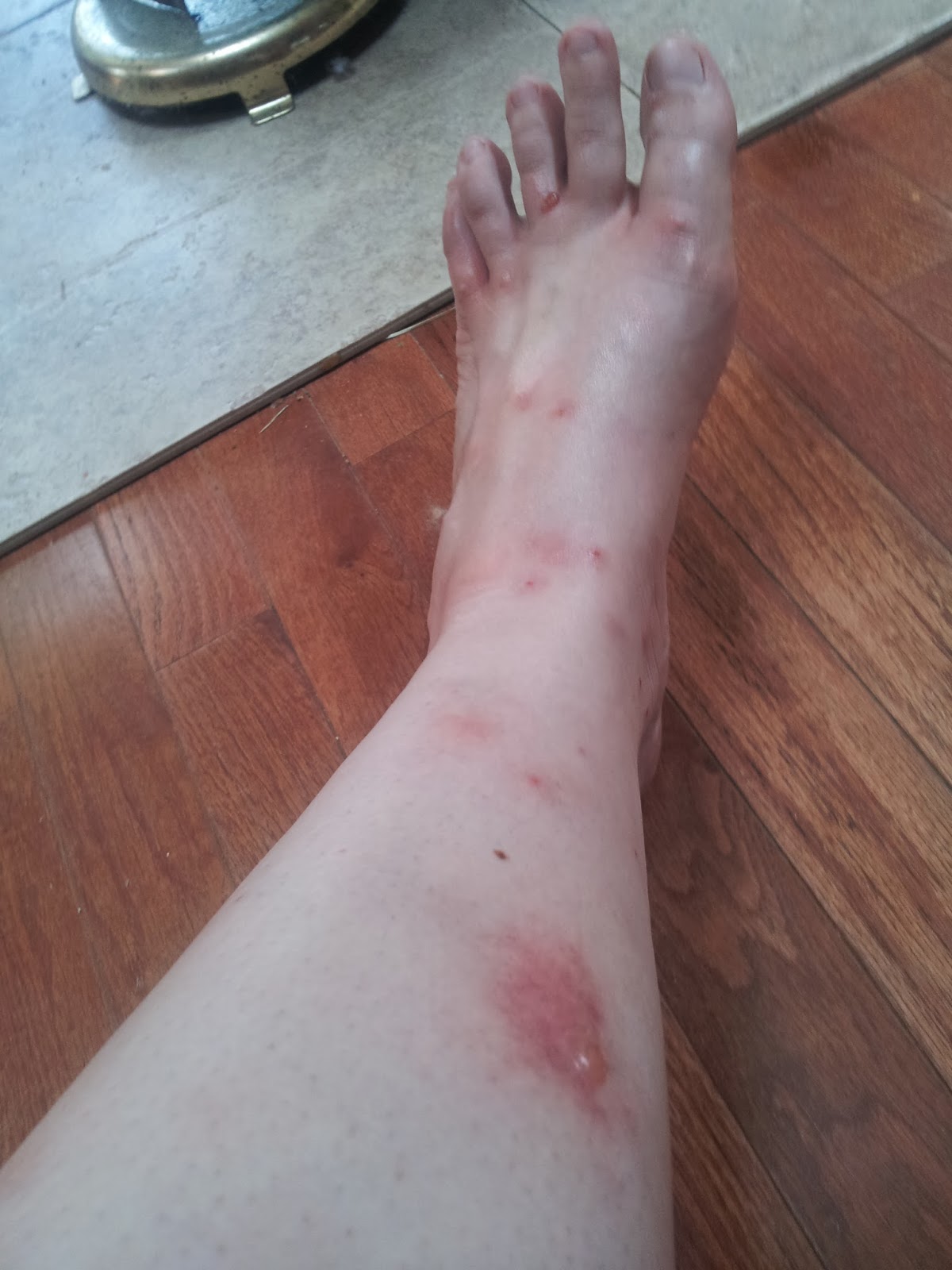 Journey to Personal Freedom: Flea Bites and Essential Oils