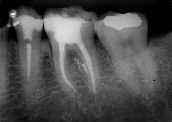 Davini - Endodontia e Microscopia Operatória: Tratamento endodôntico ...