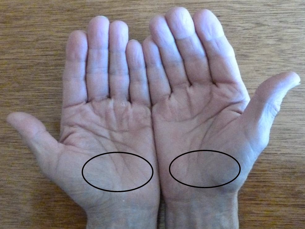 Heal Glaucoma Naturally: "Palm Pressure Therapy"