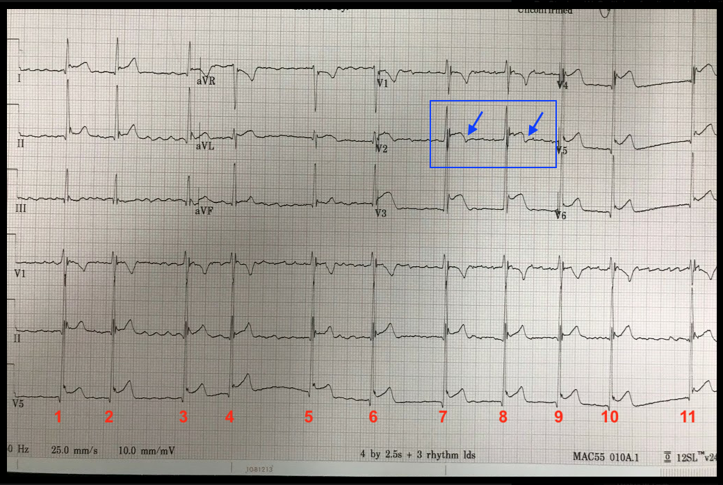 Dr Smiths Ecg Blog Palpitations And Chest Tightness Should You