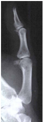 Study of the Thumb (First Digit) | Radiology