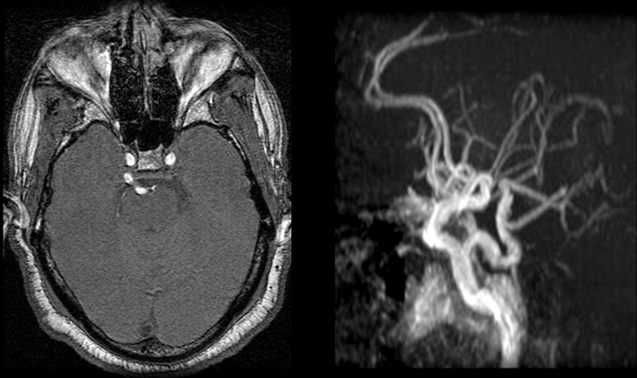 Dr Balaji Anvekar FRCR: Persistent Trigeminal Artery