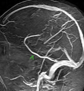 Dr Balaji Anvekar FRCR: Vein of Labbe MR Venogram Brain