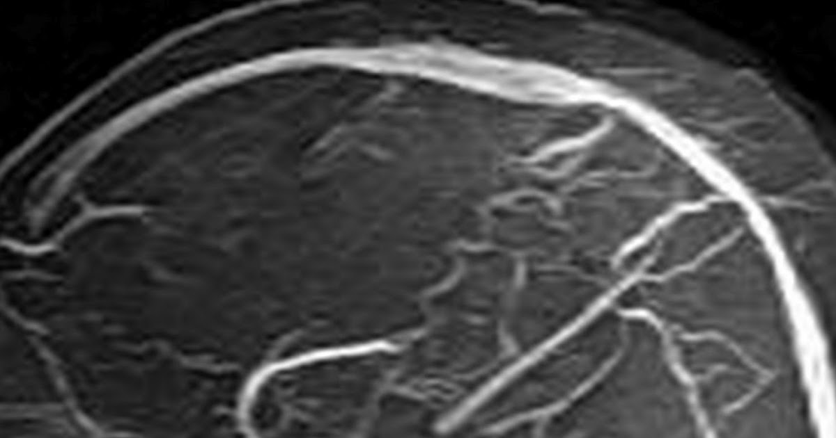 Neuroradiology Cases: Vein of Labbe MR Venogram Brain